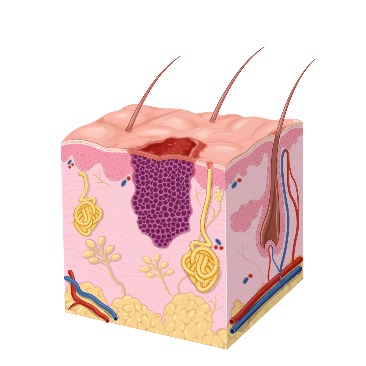 Insights on Basal Cell Carcinoma