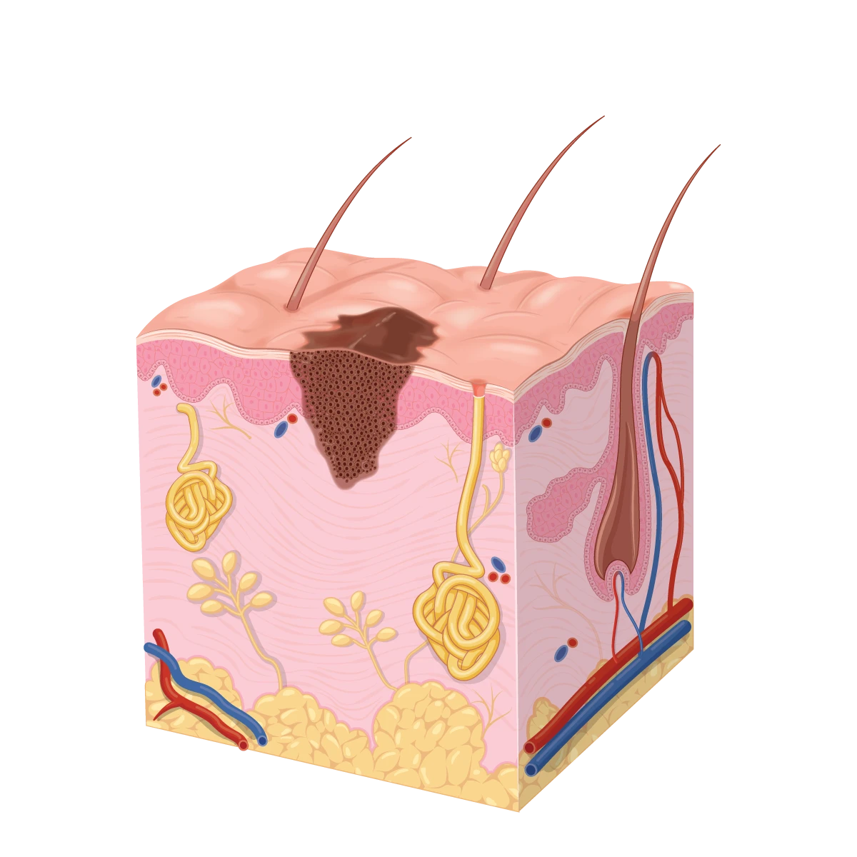 Melanoma Comprehensive Guide | Skintel