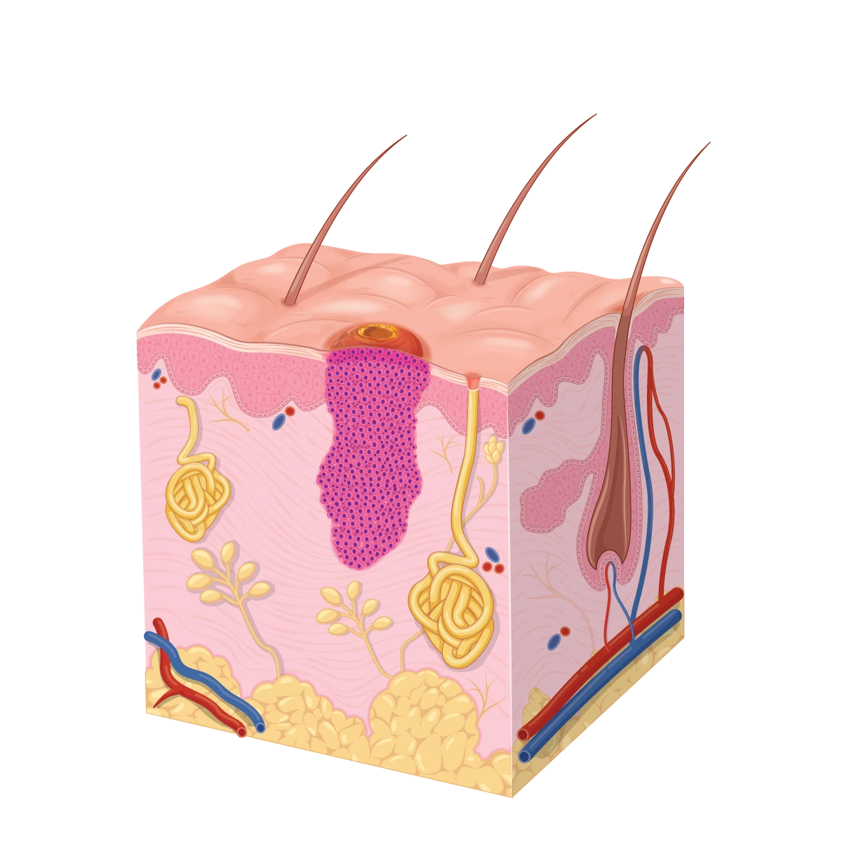 Understanding Squamous Cell Carcinoma