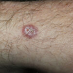 Basal Cell Carcinoma: The Definitive Guide - Skintel