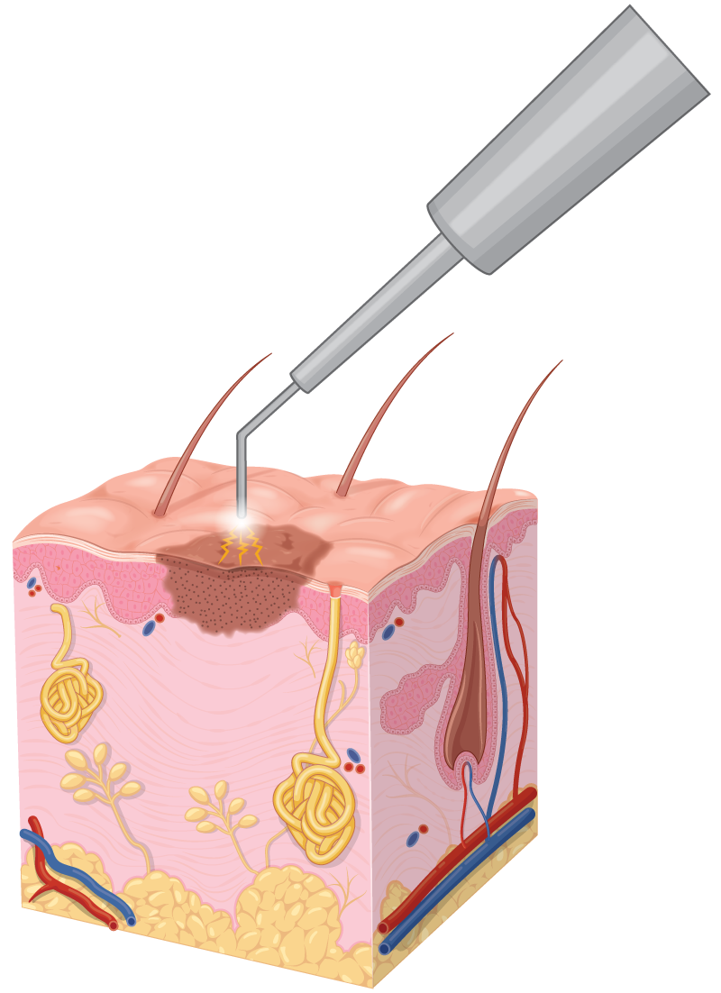 Diathermy for Skin Procedures in Auckland - Skintel