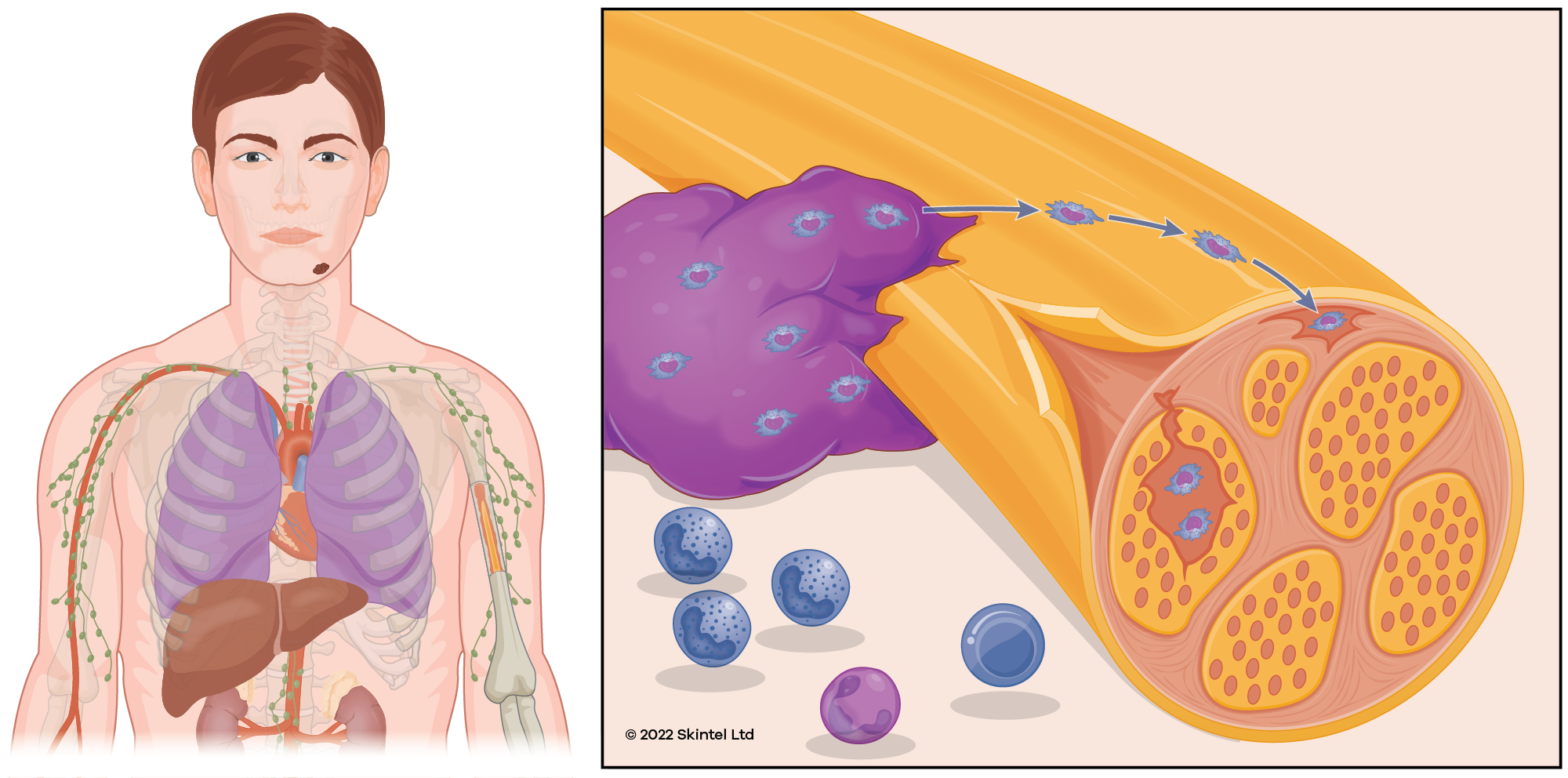 Basal Cell Carcinoma: The Definitive Guide - Skintel