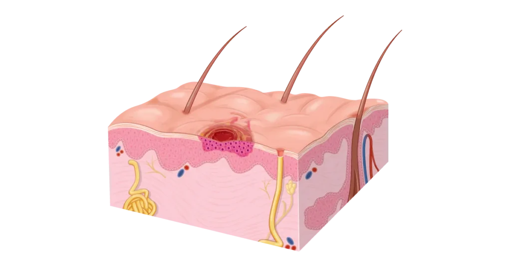 Skintel: Nicotinamide & Skin Cancer: Does It Help?