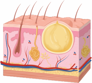 Expert Cyst Removal in Auckland | Skintel