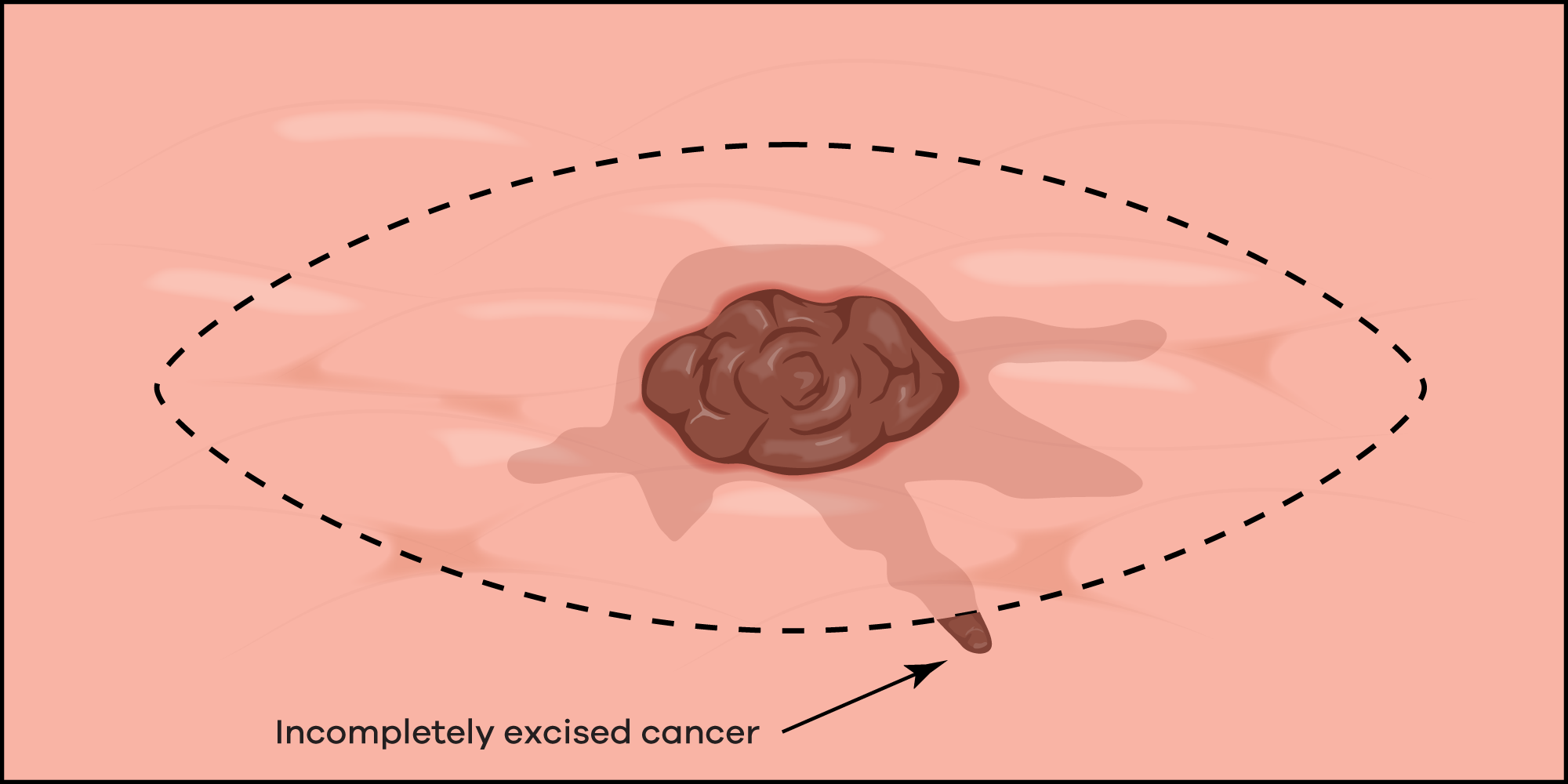Low Incomplete Excision Rate - Skintel
